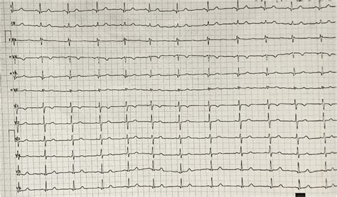 Unusually High Rhabdomyolysis Induced Hyperkalemia The American