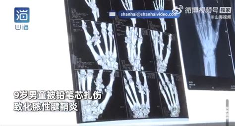 9岁男童被铅笔扎伤险截肢医生提醒小伤口大问题处理不当要人命 知乎