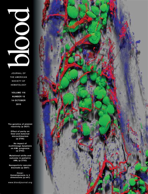 Dynamic International Prognostic Scoring System Dipss Predicts Progression To Acute Myeloid