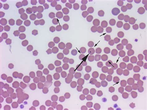 Cytology Howell Jolly Bodies And Mycoplasma Haemofelis In Cats Felis Vetlexicon