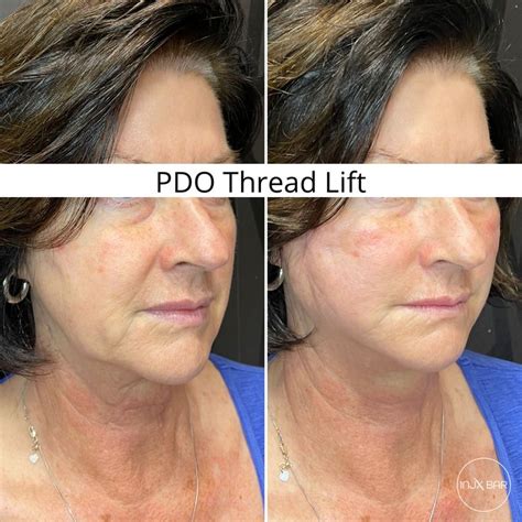 Before And After Pdo Thread Lift Results