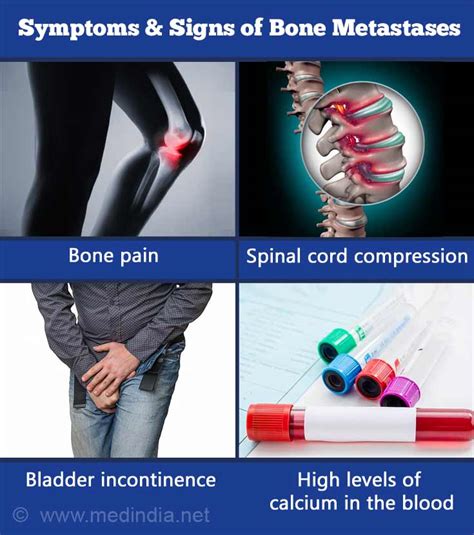 Bone Metastases Osseous Metastatic Disease Causes Symptoms