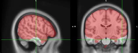 Fmriprep Bold Brain Mask Issue Software Support Neurostars