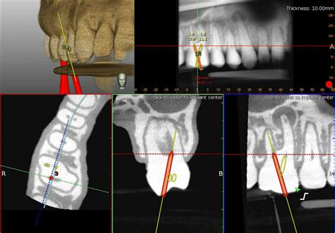 Dynamic NavigationThe Future Of Minimally Invasive Endodontics