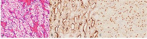 Immunohistochemistry Stain Of Excised Orbital Mass A Hematoxylin And