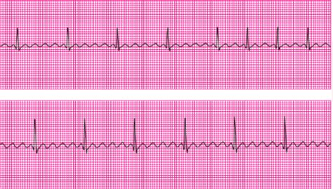 Atrial Dysrhythmias And AV Blocks ECG Flashcards Quizlet