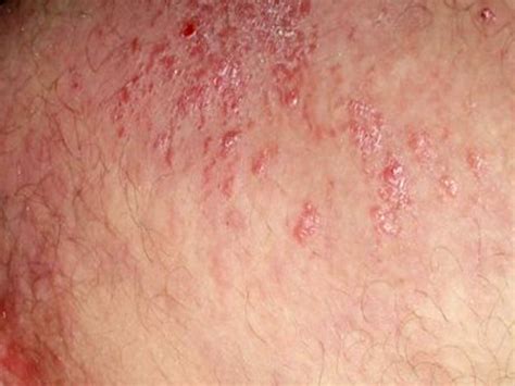 Best Fungal Infection Treatment In Pune Dr Kiran Mane Leela