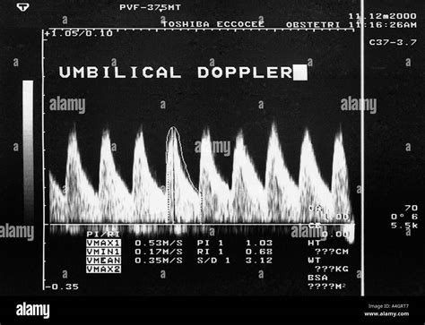 Umbilical Artery Doppler Doppler Sonography In Obstetrics