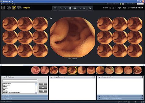 Wireless Video Capsule Endoscopy Procedure Private Gastro London