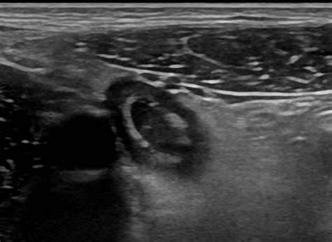 Abdomen And Retroperitoneum 1 5 Appendix Case 1 5 2 Uncomplicated Appendicitis Ultrasound