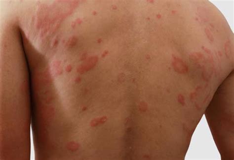 Angioedema Causes And Symptoms Americas Best Care Plus