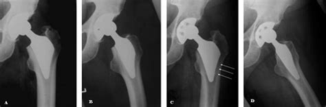 Short Stem Hip Arthroplasty Intechopen