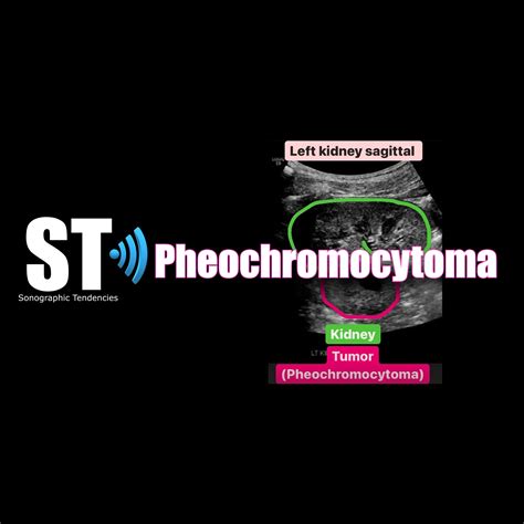 Pheochromocytoma Sonographic Tendencies