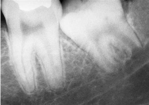 Oral Surgery Impacted Teeth Flashcards Quizlet