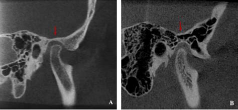 Cone Beam Computed Tomography Sagittal Sections Showing Absence Of Download Scientific Diagram