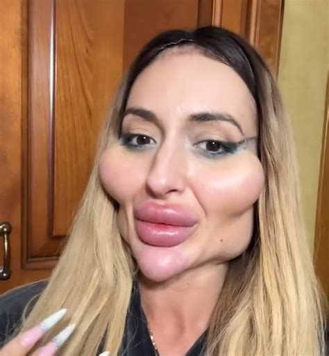 A Woman Gets Multiple Surgeries To Have “the Worlds Biggest Cheeks