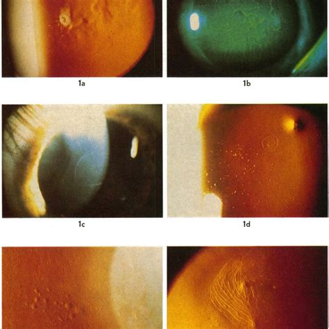What Causes Anterior Basement Membrane Dystrophy Openbasement
