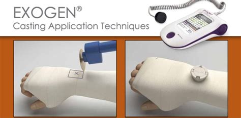 Exogen Casting Application Techniques Exogen Ultrasound Bone Healing