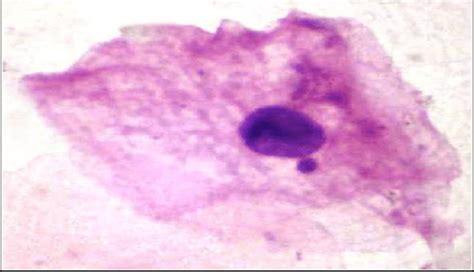 Exfoliative Buccal Cell Showing Micronucleus Pap Stained1000x