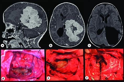 Choroid Plexus Papilloma Choroid Plexus Papilloma
