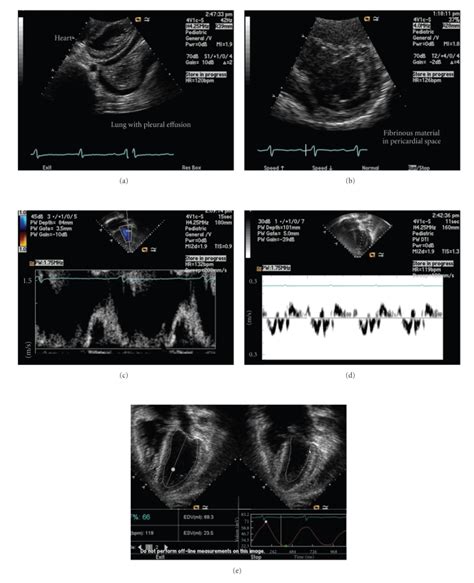 Echocardiogram Showing A Pericardial Effusion And Pleural Effusion At Download Scientific