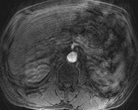 Transient Respiratory Motion Artifact During Arterial Phase Mri With