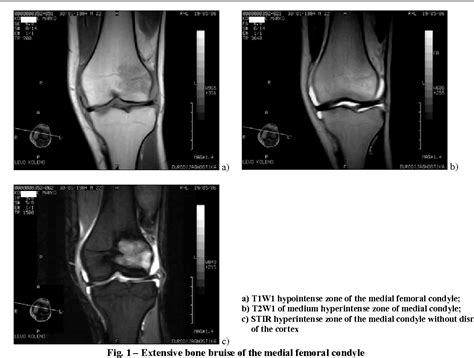 Bone Bruising Around The Knee