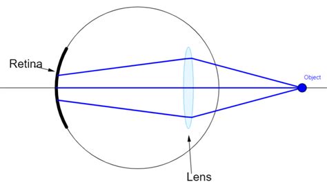 Distinguish Between Myopia And Hypermetropia