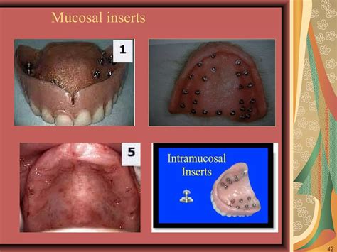Implant Classification Ppt