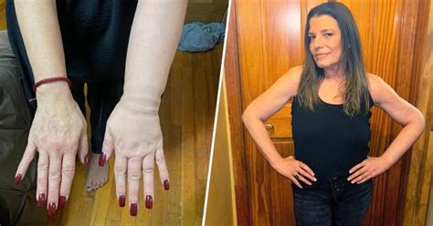 Can Weight Loss Drugs Help Treat Lymphedema Doctor Sees Incredible