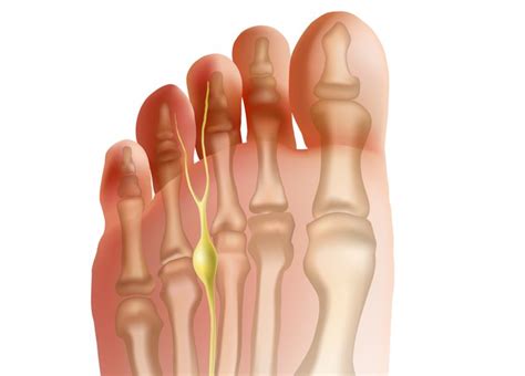 Saddle Bone Deformity Throw The Kitchen Sink At It Foot Problems
