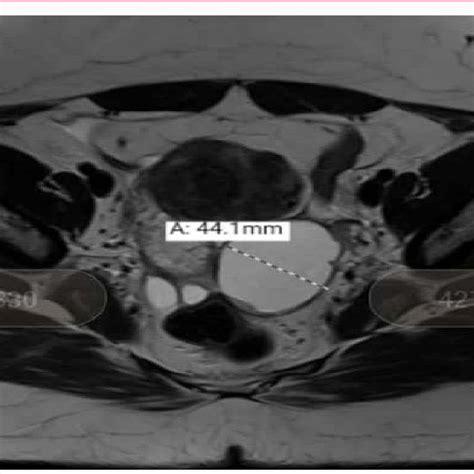Mri Axial Section Demonstrates Left Ovarian Mass Download Scientific