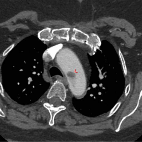 Cta Aortogram Showing A Non Occlusive Distal Aortic Arch Filling Defect Download Scientific