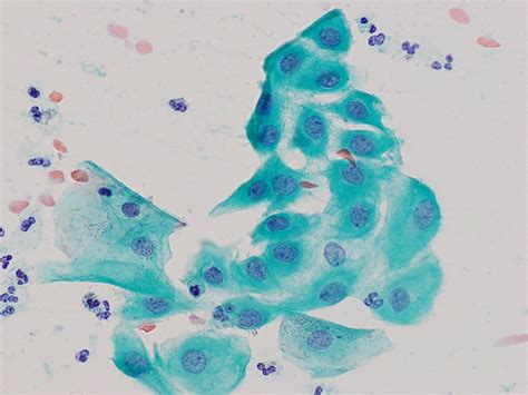 Pathology Outlines Squamous Metaplasia