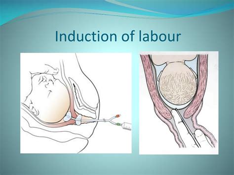 Ppt Induction Of Labor Powerpoint Presentation Free Download Id1756838