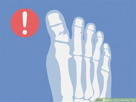 How To Heal A Broken Toe 13 Steps With Pictures WikiHow
