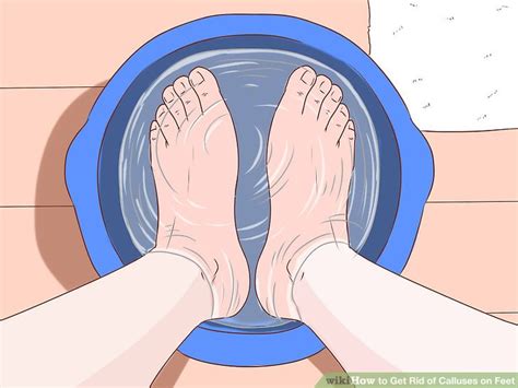 Ways To Get Rid Of Calluses On Feet WikiHow