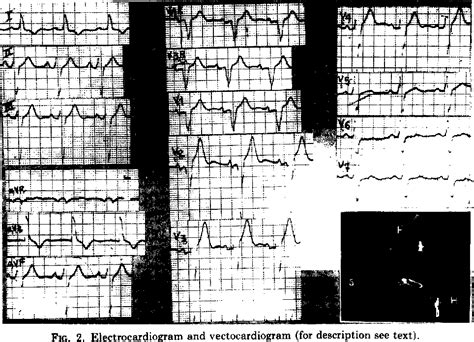 Figure 2 From Massive Calcification Of The Myocardium Semantic Scholar