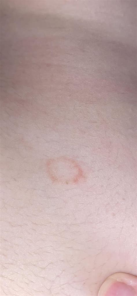 What Is This Small Circular Shaped Rash R Dermatology