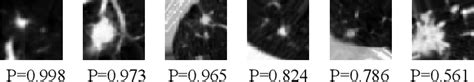 Figure 6 From False Positive Reduction Of Pulmonary Nodule Detection Based On Deformable