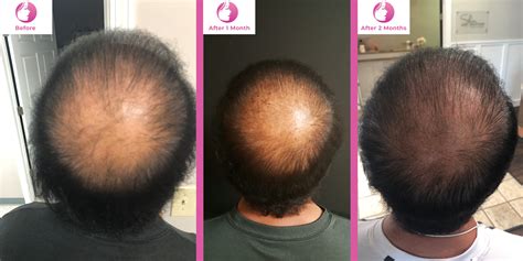 Knoxville PRP Injections For Hair Loss Pretty Girl Aesthetics