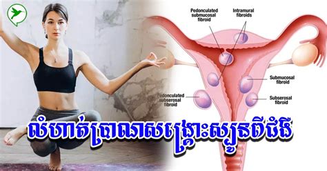 ស្រ្តីមិនគួររំលង លំហាត់ប្រាណ៥ក្បាច់ ជួយពង្រឹងប្រព័ន្ធការពារស្បូនគេចជំងឺគ្រប់មុខ