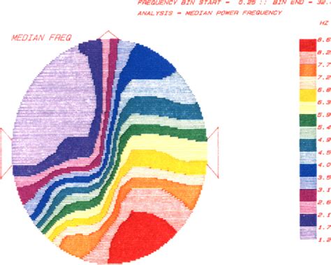 Figure 1 From Clinical Utility Of Topographic Eeg Brain Mapping Semantic Scholar