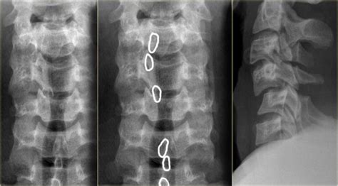 Bilateral Facet Dislocation