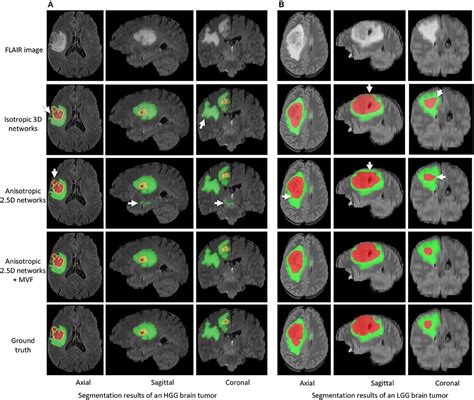 Frontiers Automatic Brain Tumor Segmentation Based On Cascaded