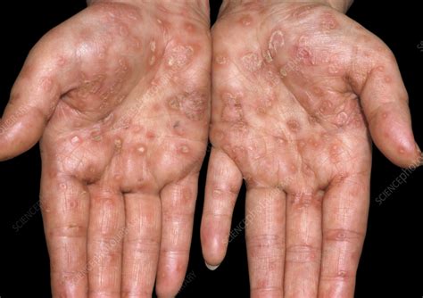 Secondary Syphilis Lesions On A Womans Hands Stock Image C0585727
