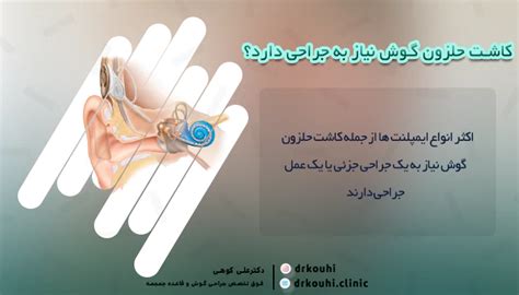 انواع کاشت حلزون گوش آشنایی با کاشت حلزون دکتر کوهی