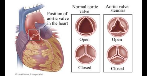 Pechakucha Presentation Patient Decision Aids In Prosthetic Heart Valve Se