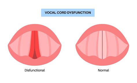 Vocal Cord Dysfunction Causes Symptoms And Care