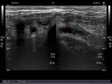 Figure 2 From Apendicitis Aguda Seguimiento De 4 Años Semantic Scholar